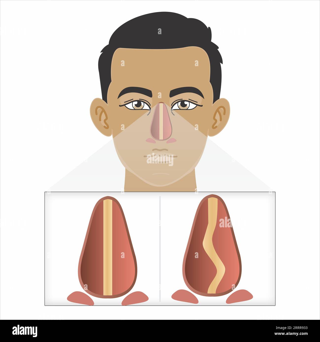Broken nasal cartilage illustration injury Stock Photo - Alamy