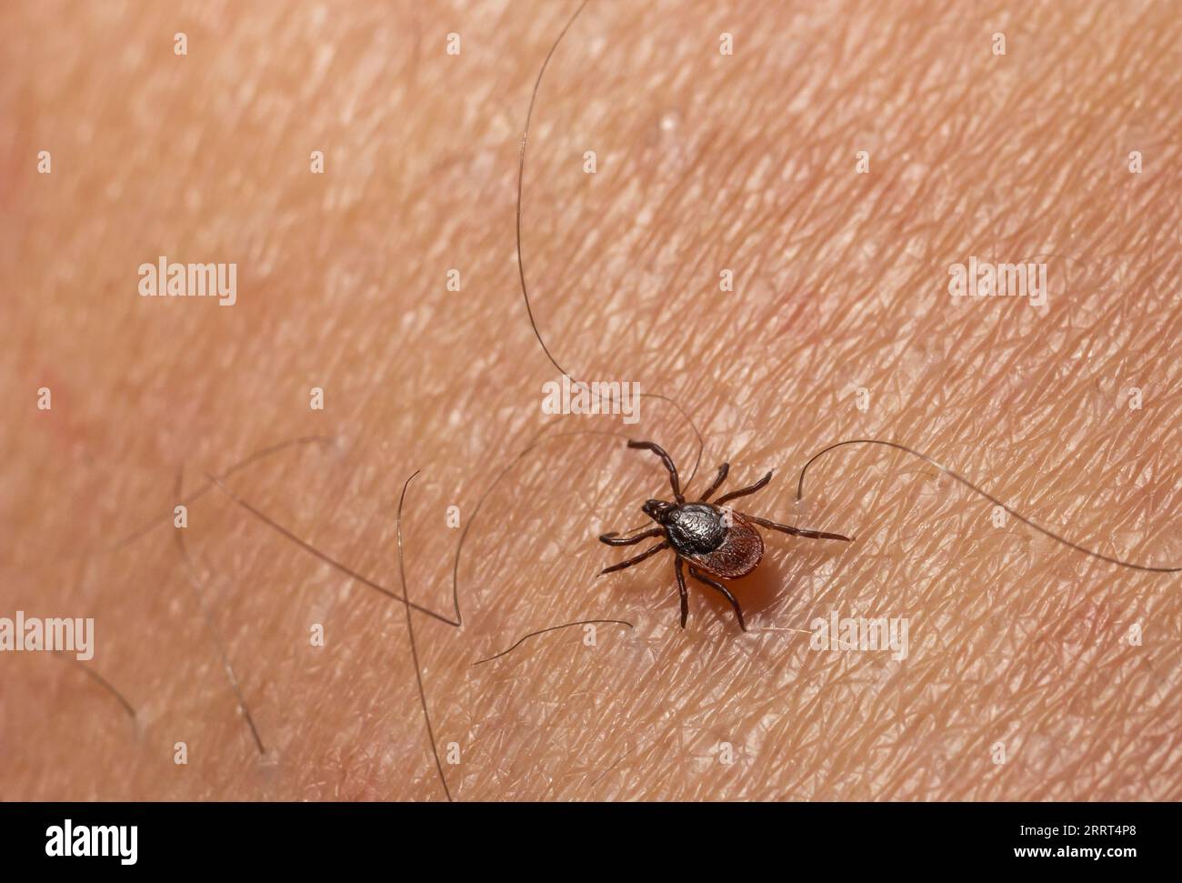 The parasite mite sits on a persons skin. infection carrier. Ixodes ...