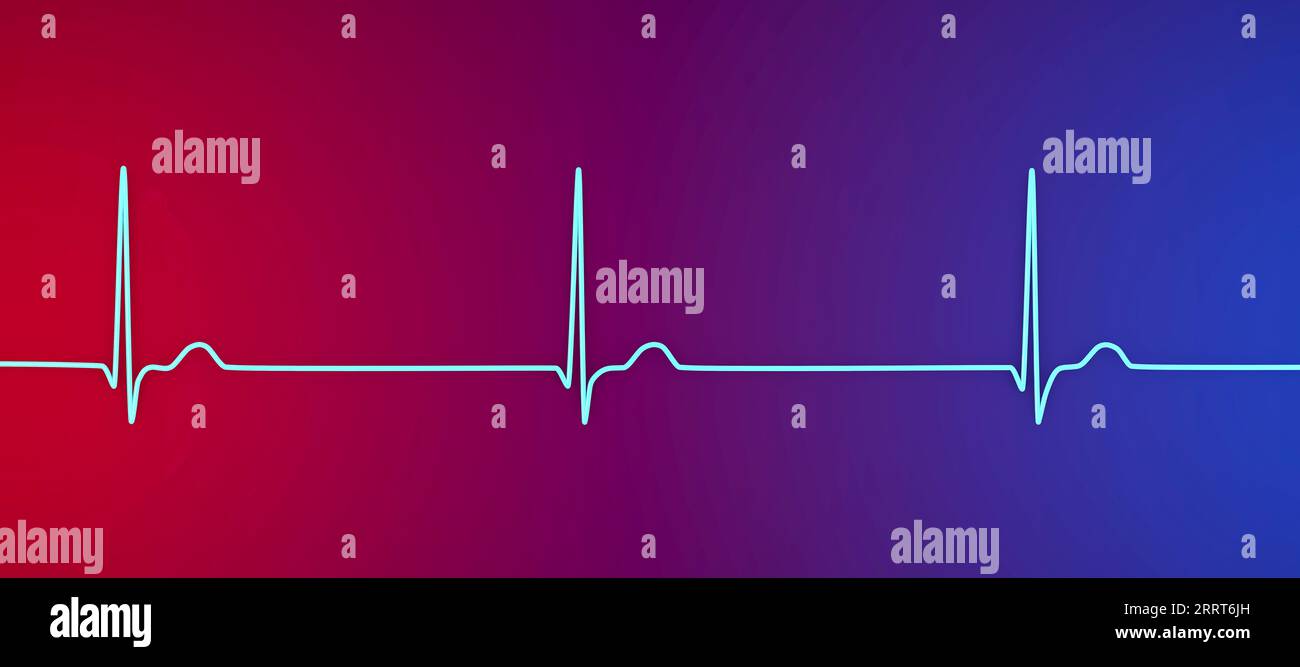Junctional rhythm of the heartbeat, illustration Stock Photo - Alamy