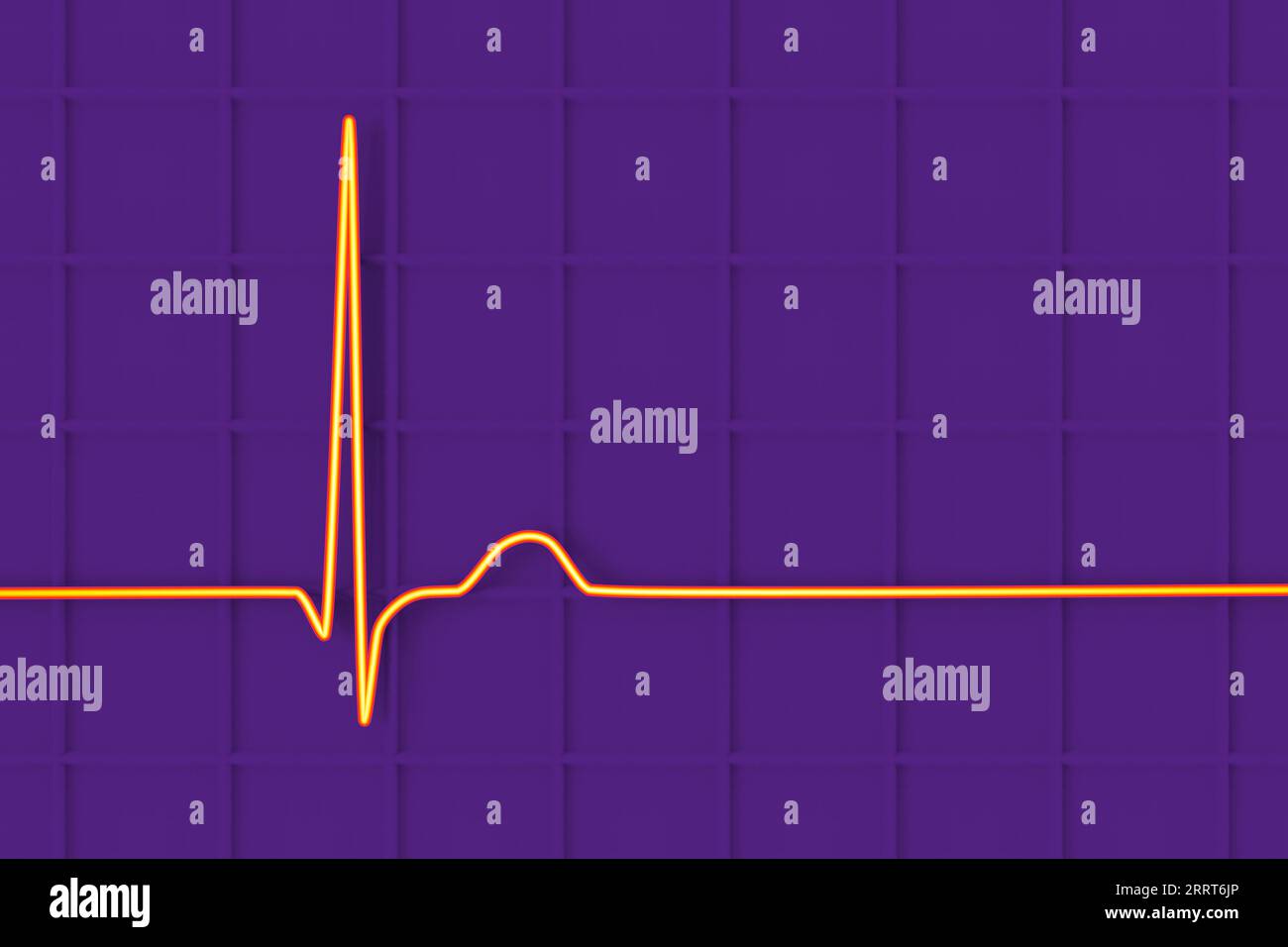 Junctional rhythm of the heartbeat, illustration Stock Photo - Alamy
