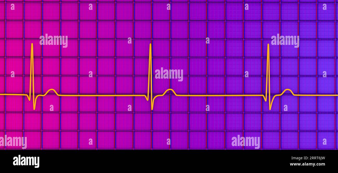 Junctional rhythm of the heartbeat, illustration Stock Photo - Alamy