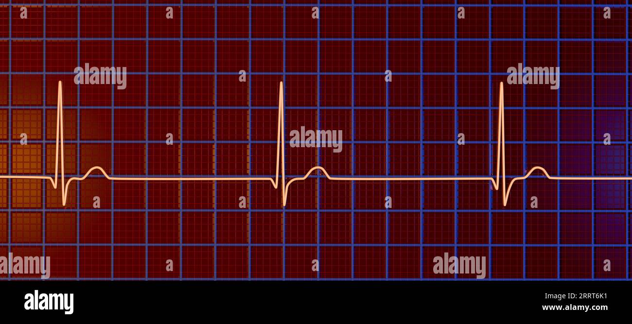 Junctional rhythm hi-res stock photography and images - Alamy