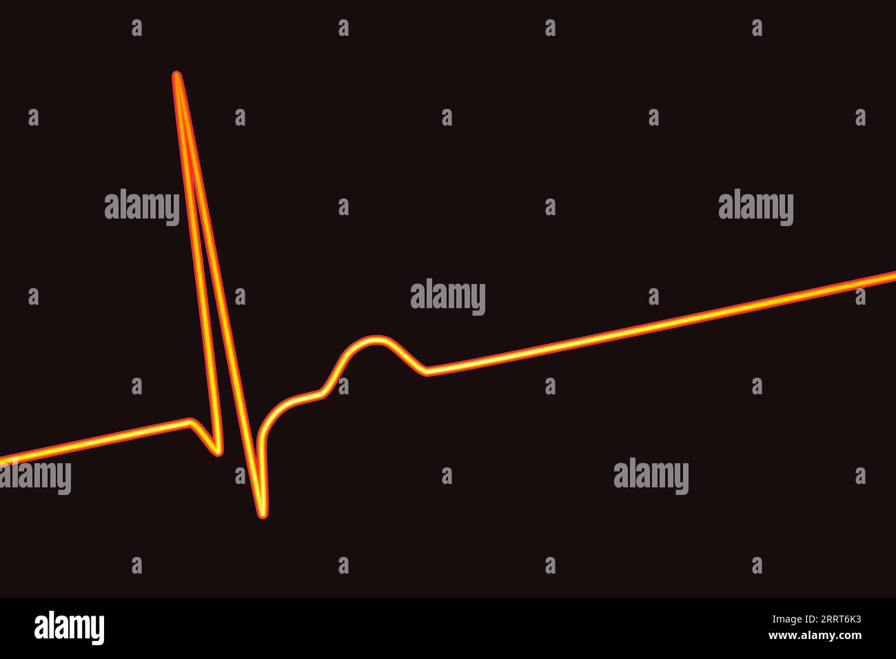 Junctional rhythm of the heartbeat, illustration Stock Photo - Alamy