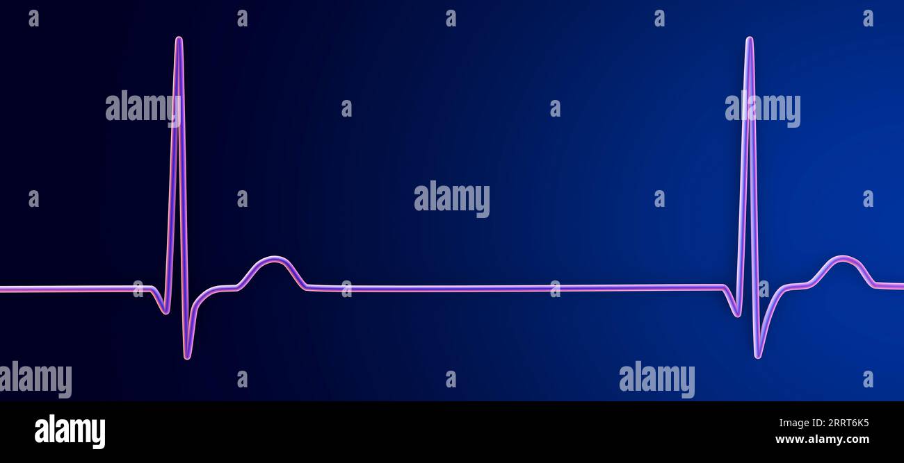Junctional rhythm of the heartbeat, illustration Stock Photo - Alamy