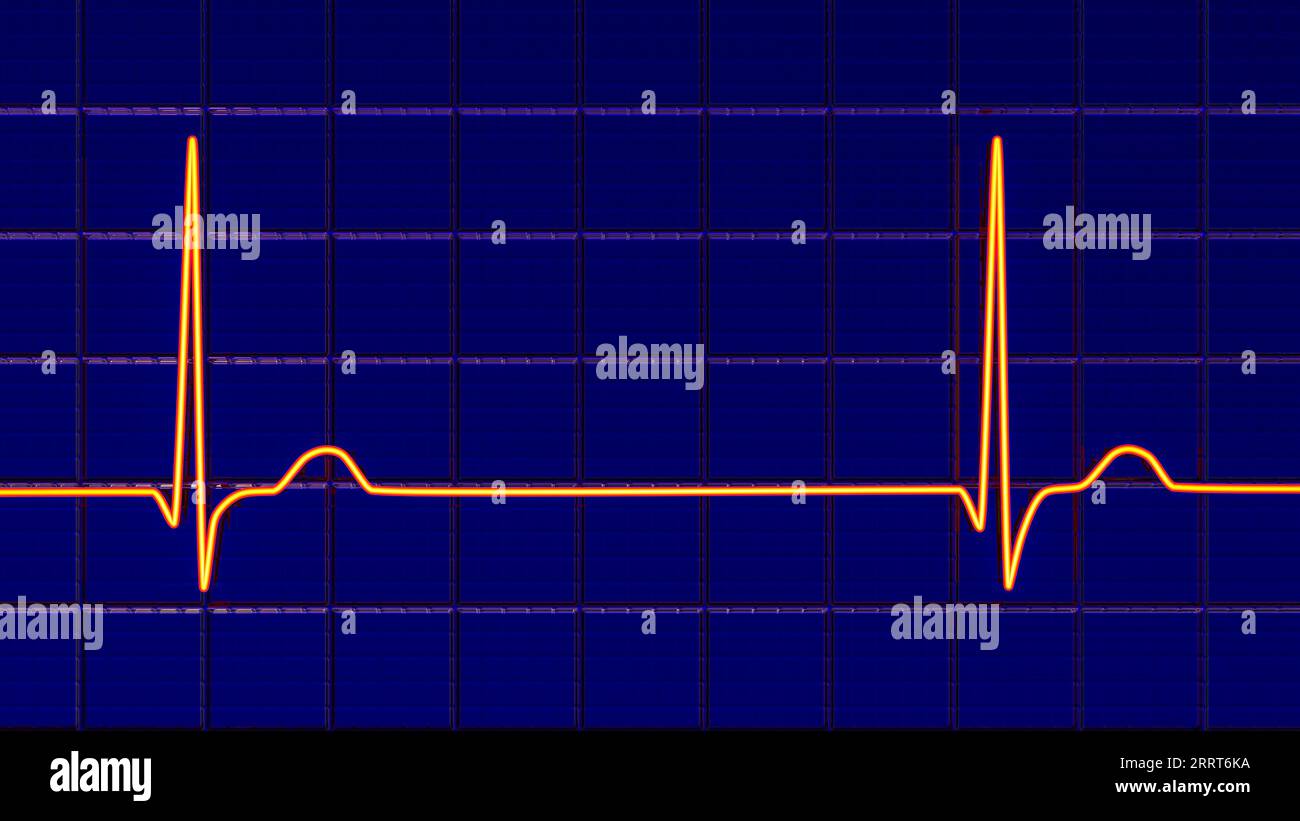 Junctional rhythm hi-res stock photography and images - Alamy