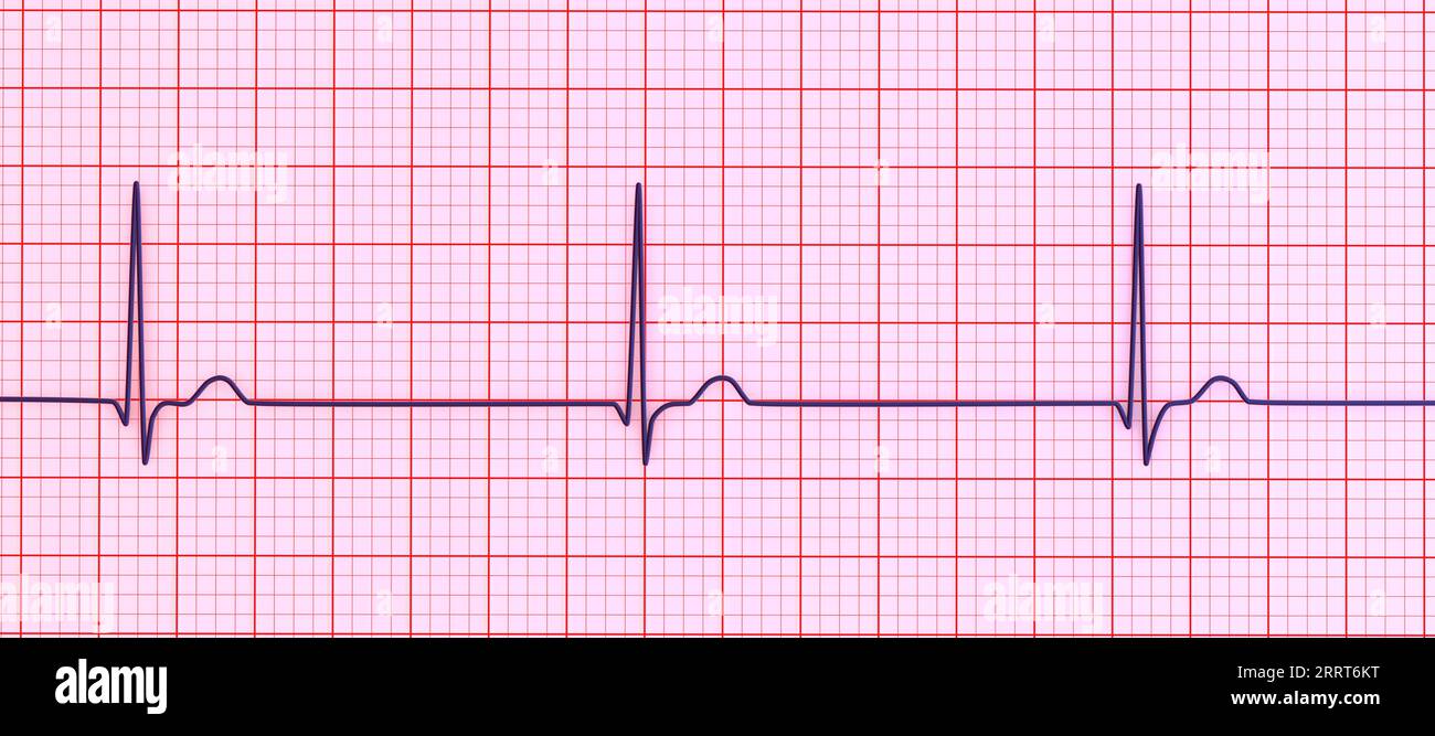 Junctional rhythm of the heartbeat, illustration Stock Photo - Alamy