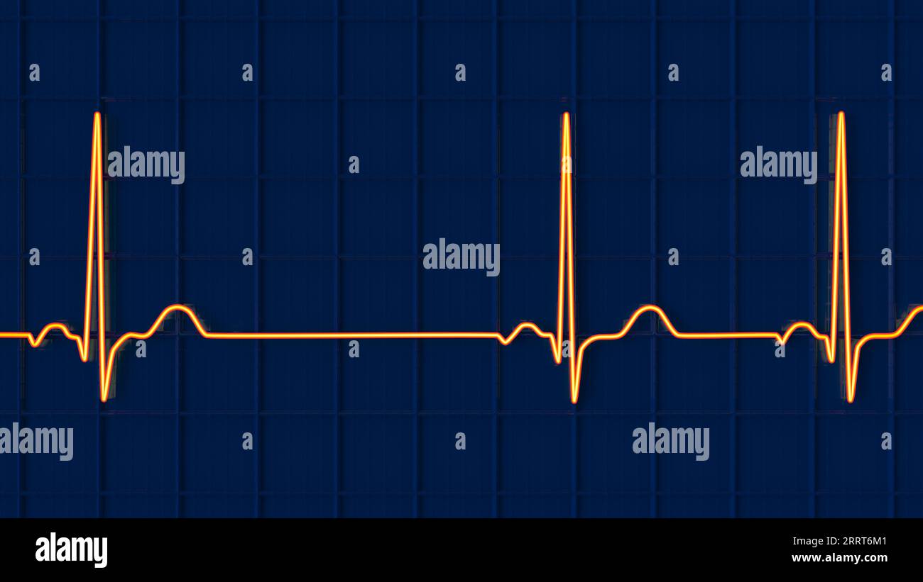 Sinus arrhythmia heartbeat rhythm, illustration Stock Photo - Alamy