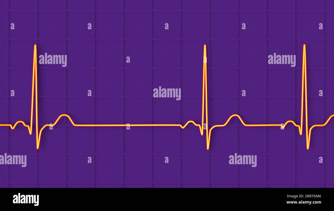 Sinus arrhythmia heartbeat rhythm, illustration Stock Photo - Alamy