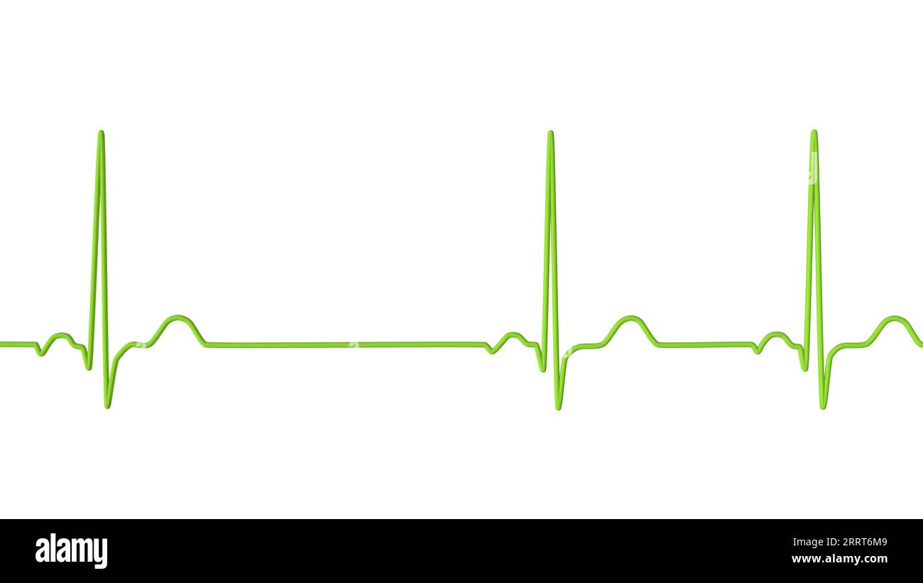Sinus arrhythmia heartbeat rhythm, illustration Stock Photo - Alamy