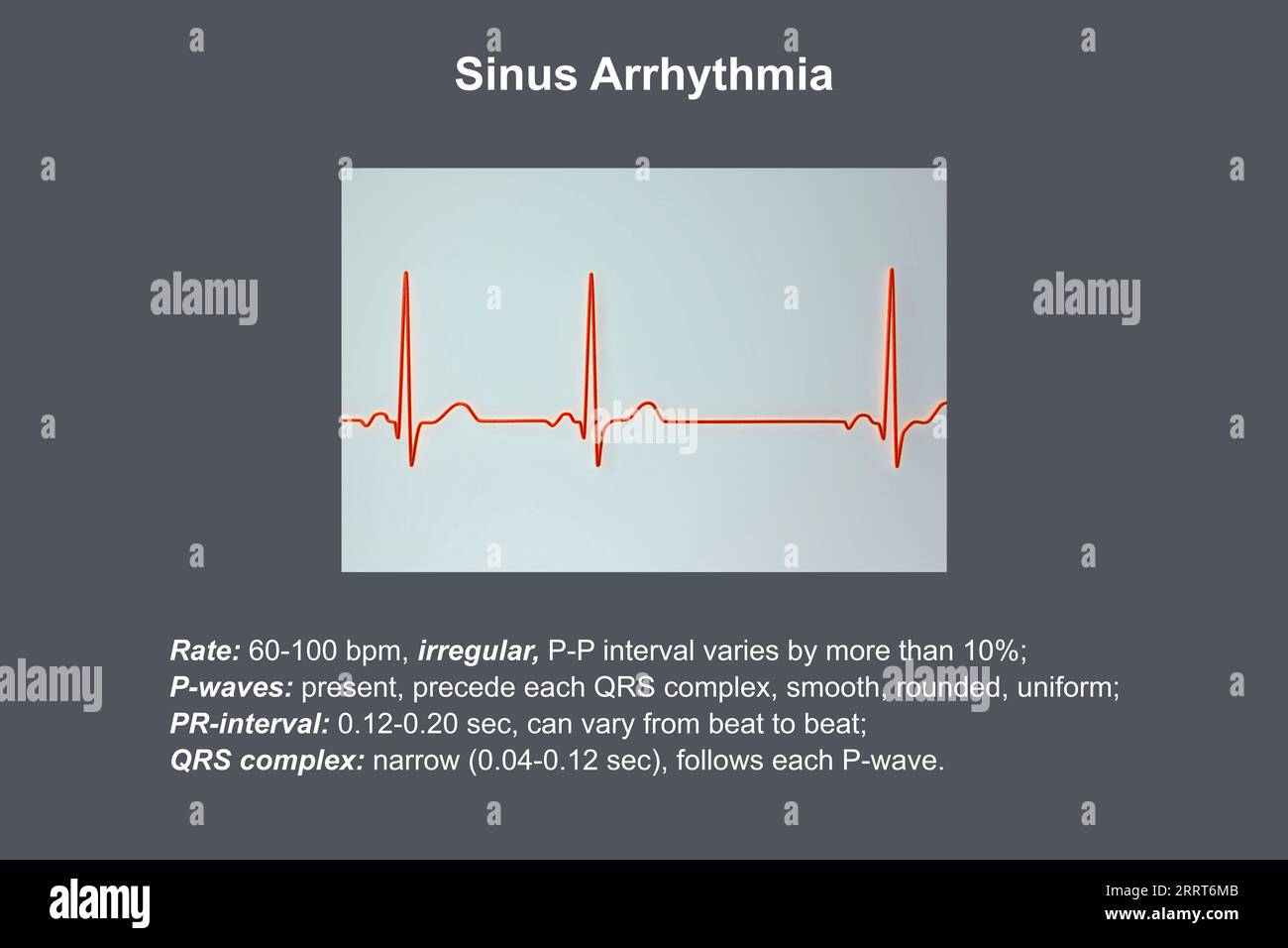 Sinus arrhythmia heartbeat rhythm, illustration Stock Photo - Alamy