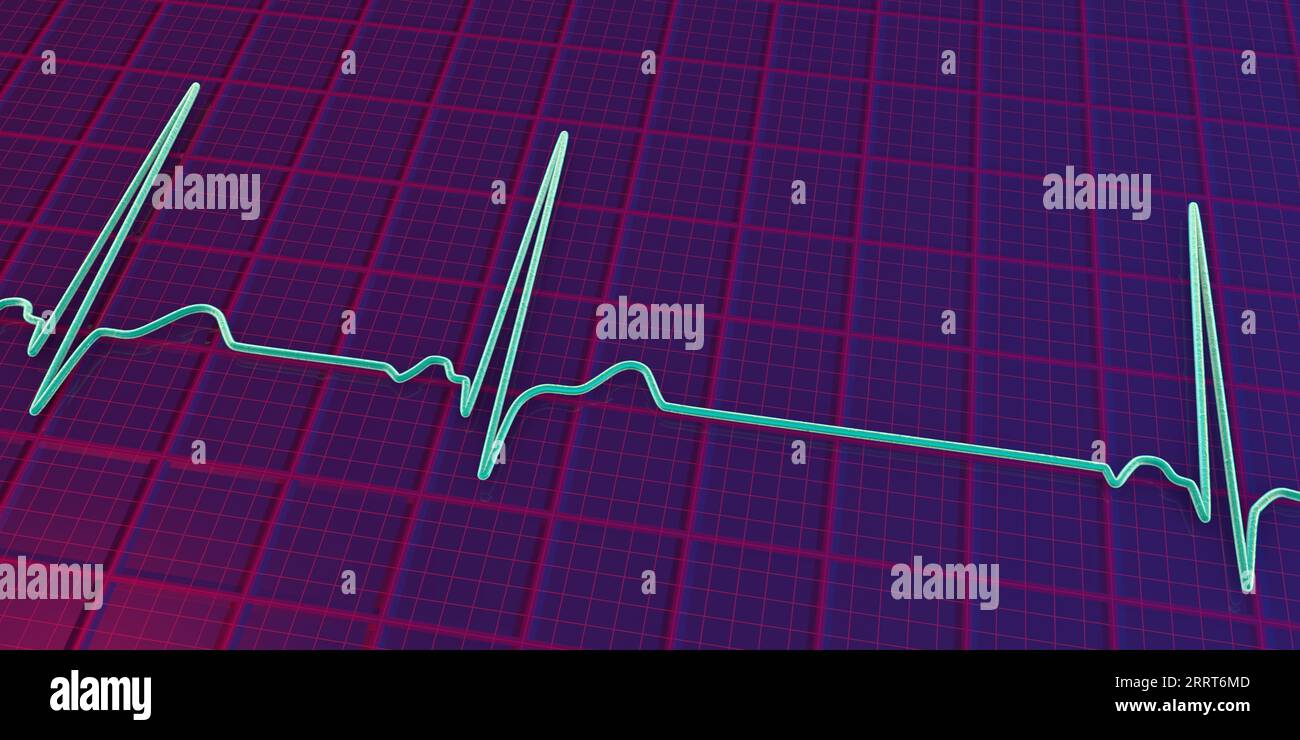 Sinus arrhythmia heartbeat rhythm, illustration Stock Photo - Alamy