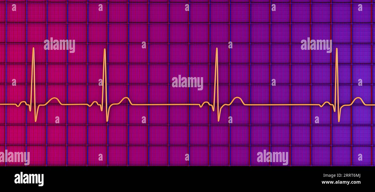 Sinus arrhythmia heartbeat rhythm, illustration Stock Photo - Alamy