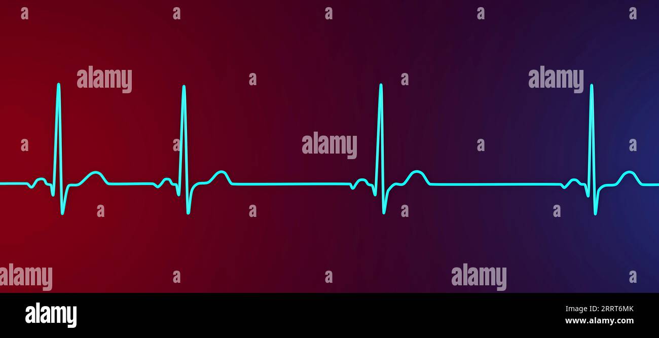 Sinus arrhythmia heartbeat rhythm, illustration Stock Photo - Alamy