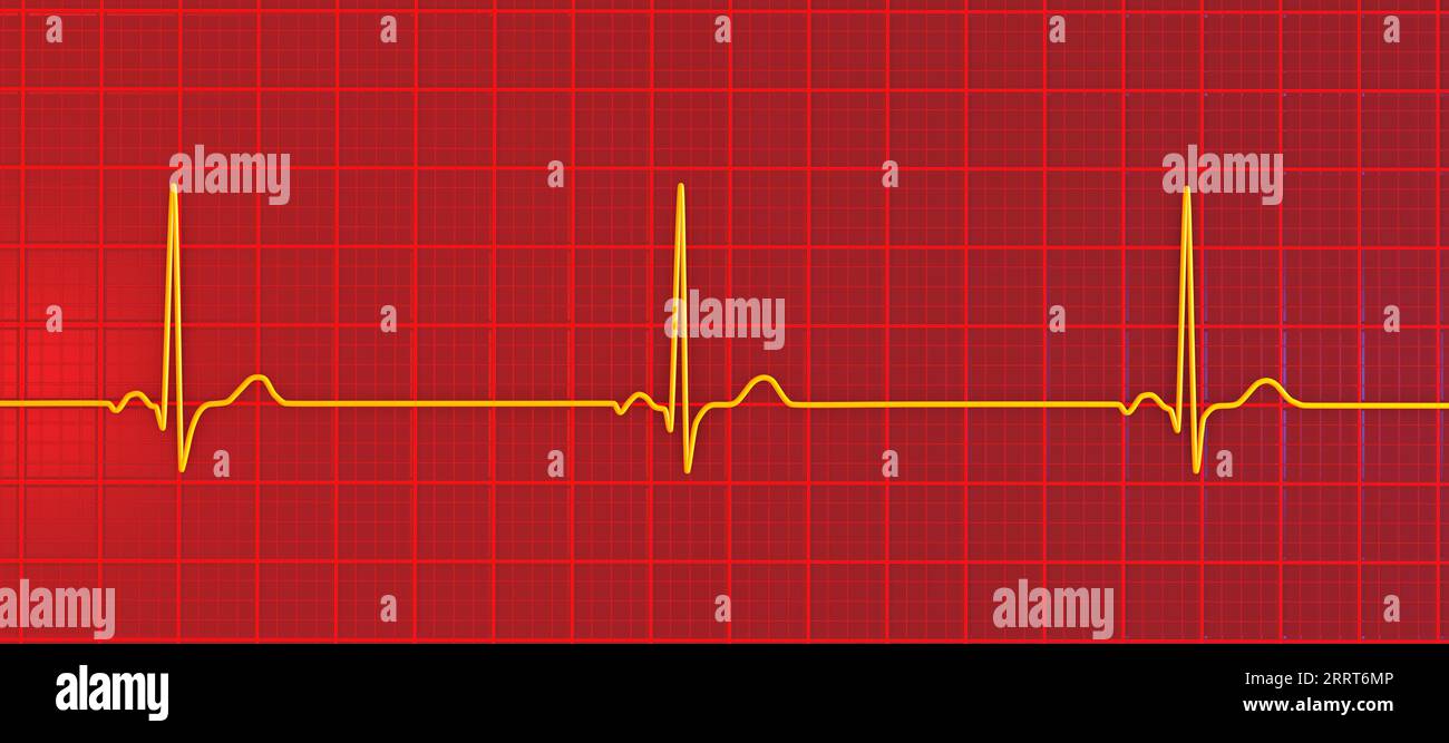 Sinus bradycardia heartbeat rhythm, illustration Stock Photo - Alamy