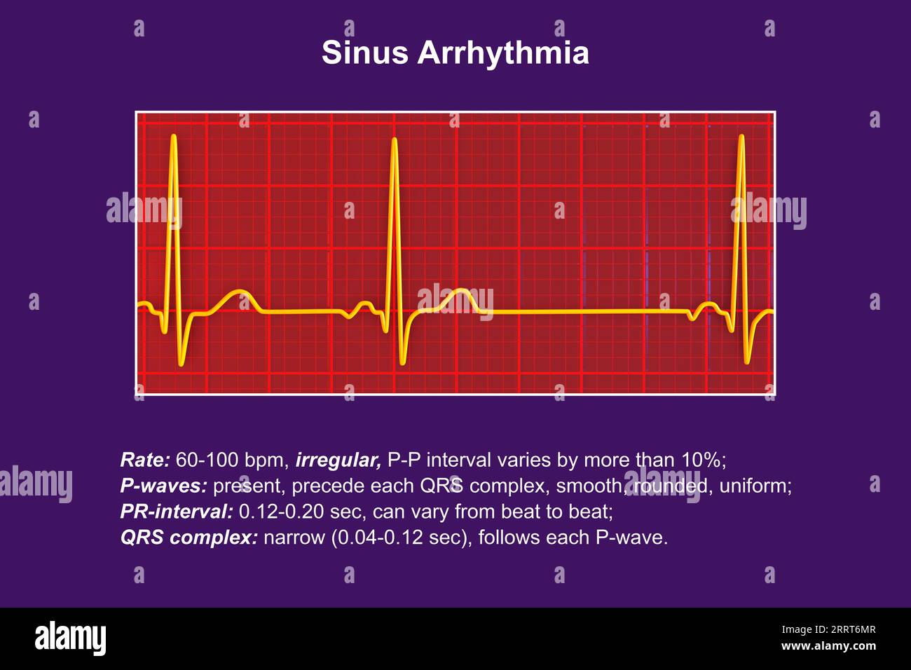 Sinus arrhythmias hi-res stock photography and images - Alamy