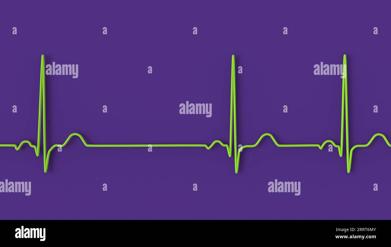 Sinus arrhythmia heartbeat rhythm, illustration Stock Photo - Alamy
