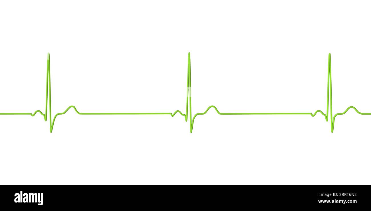 Sinus bradycardia heartbeat rhythm, illustration Stock Photo - Alamy