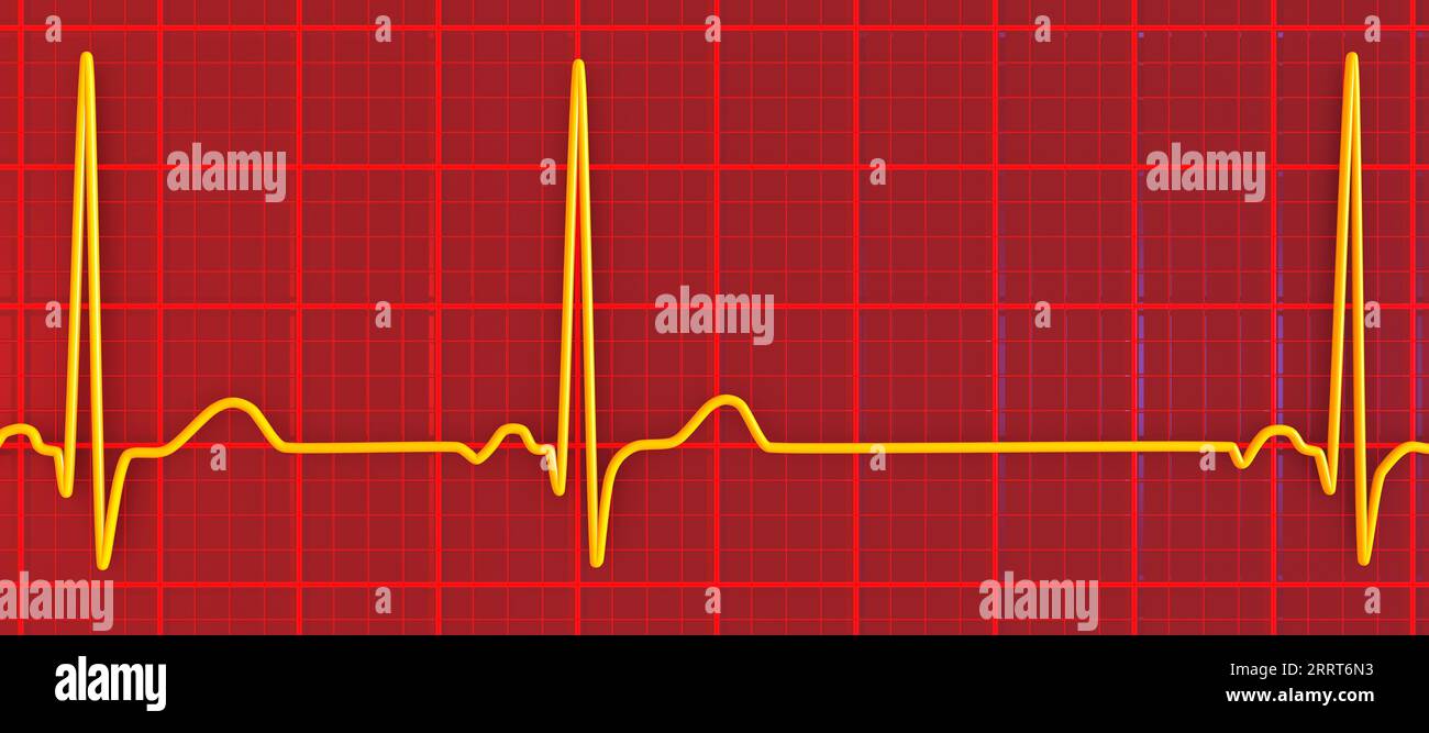Sinus arrhythmia heartbeat rhythm, illustration Stock Photo - Alamy