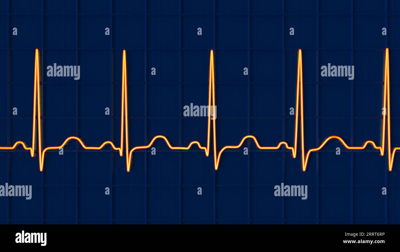 Sinus tachycardia heartbeat rhythm, illustration Stock Photo - Alamy
