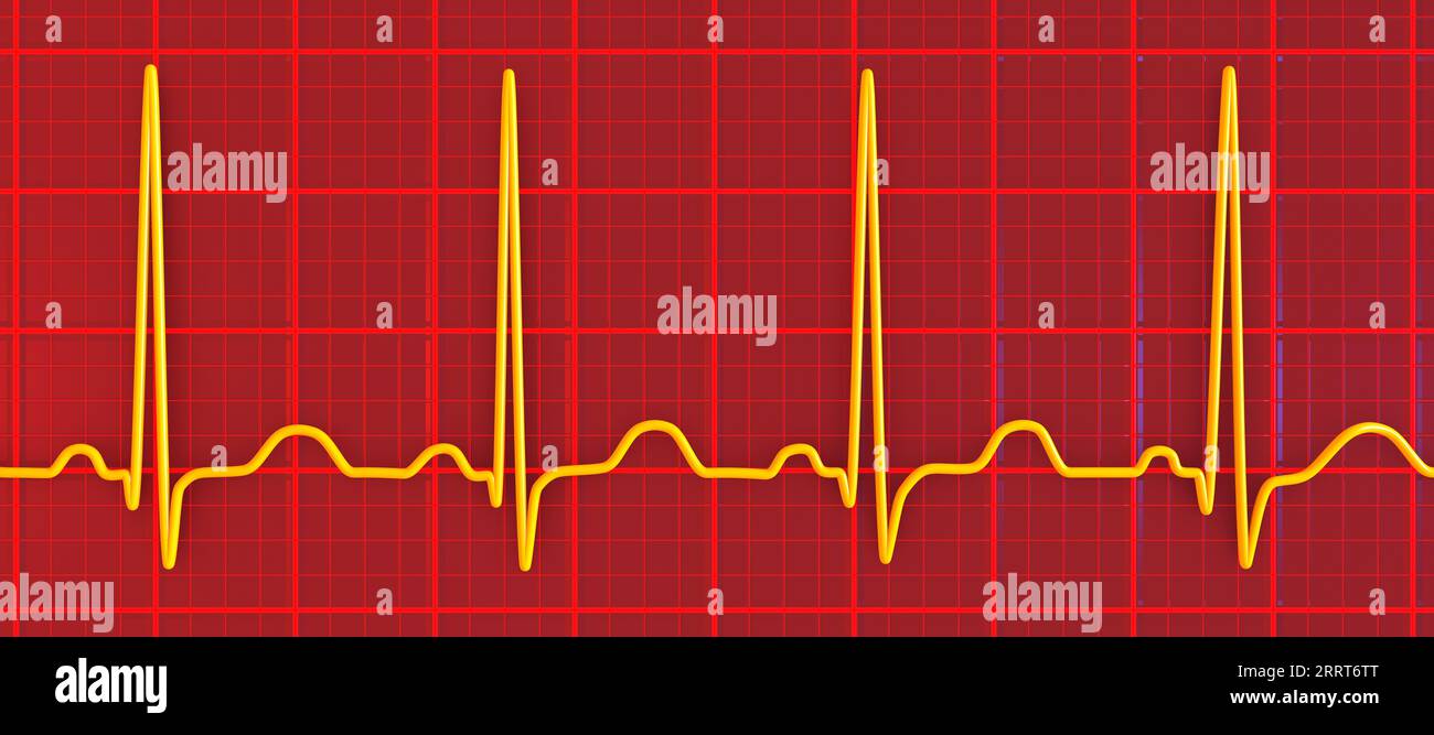Sinus tachycardia heartbeat rhythm, illustration Stock Photo - Alamy