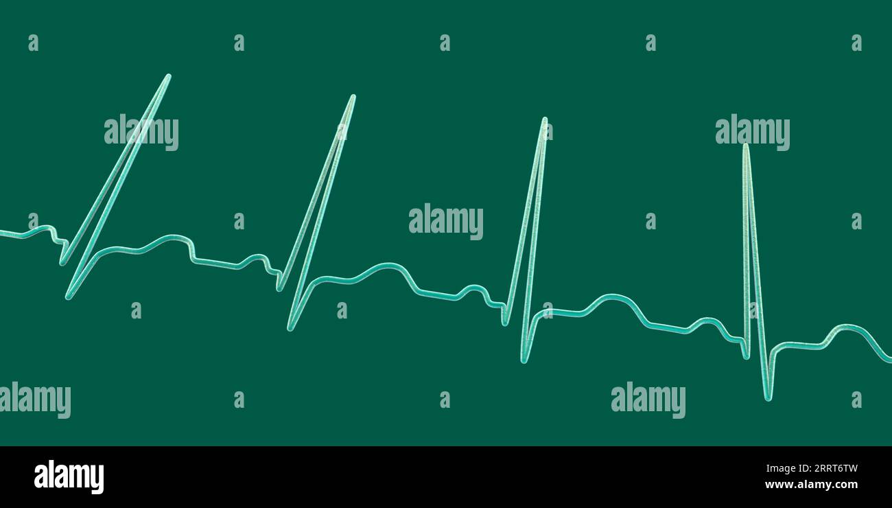 Sinus tachycardia heartbeat rhythm, illustration Stock Photo - Alamy