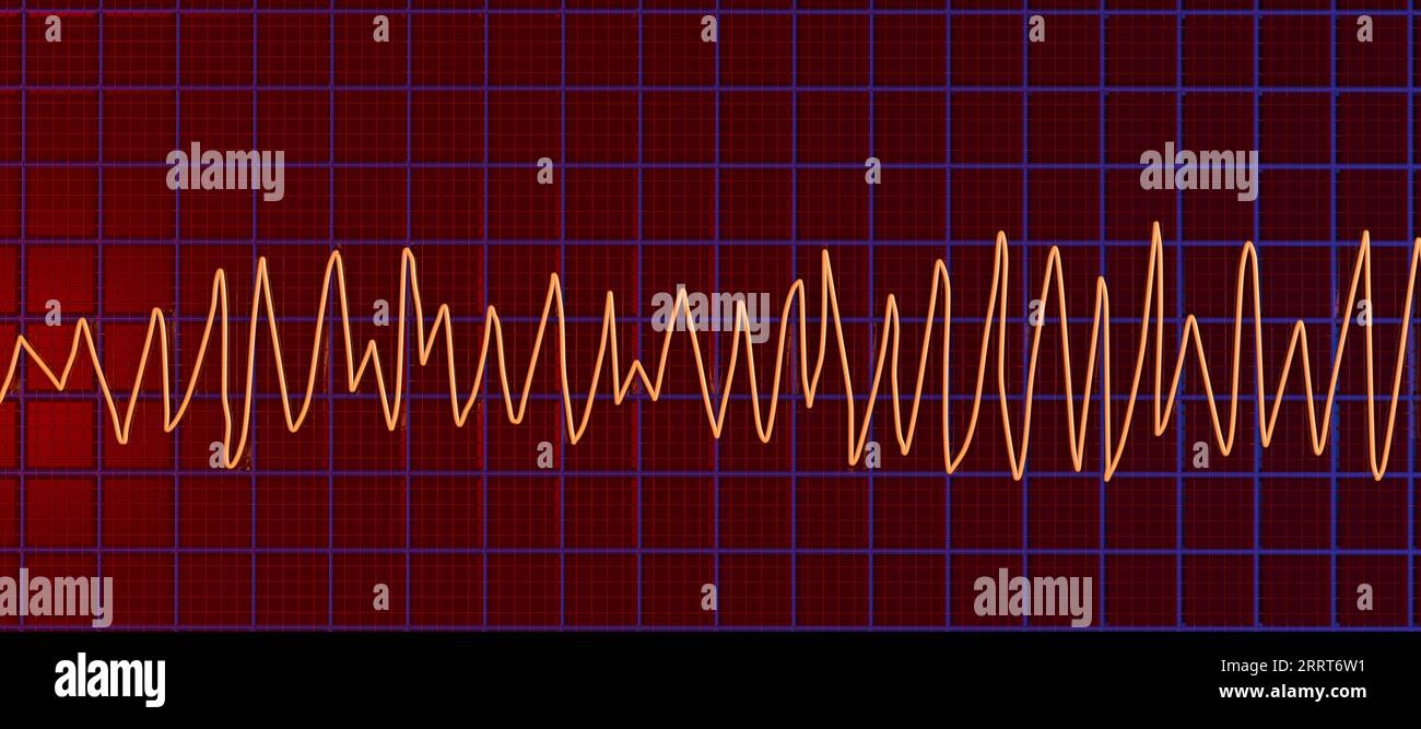 Torsades de pointes heartbeat rhythm, illustration Stock Photo - Alamy