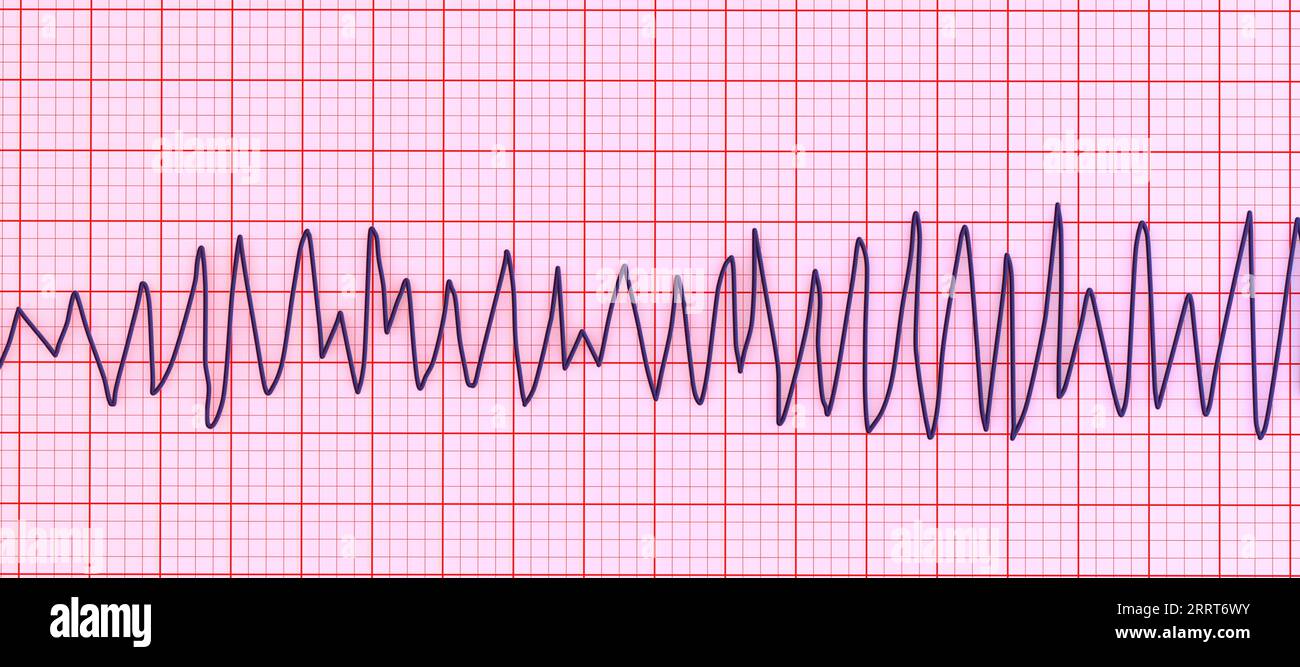 Torsades de pointes heartbeat rhythm, illustration Stock Photo - Alamy