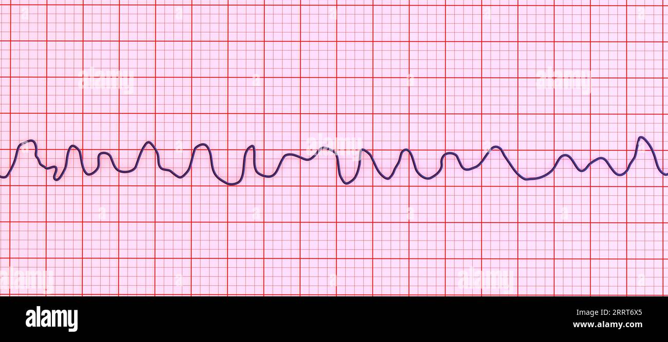 Illustration of an electrocardiogram (ECG) displaying the chaotic ...