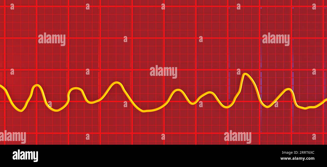 Ventricular fibrillation heartbeat rhythm, illustration Stock Photo - Alamy