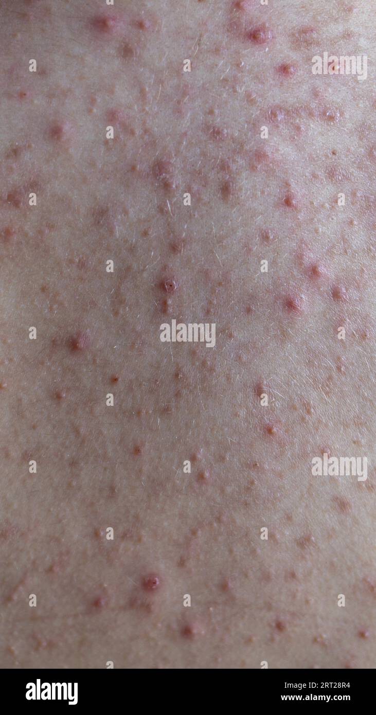 woman back with acne, red spots, skin disease Stock Photo - Alamy