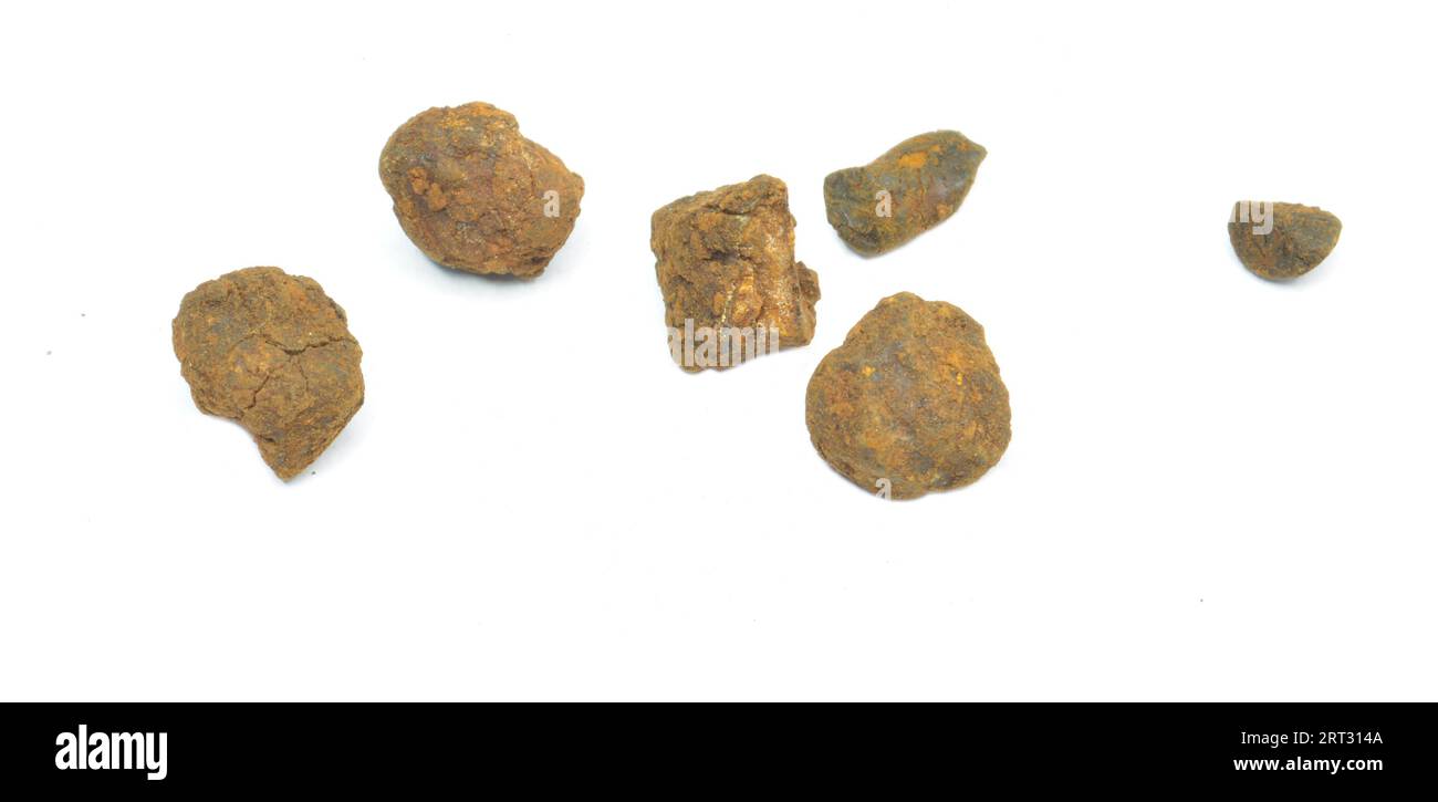 Liver stones - small stones often developed when there is an excess of ...