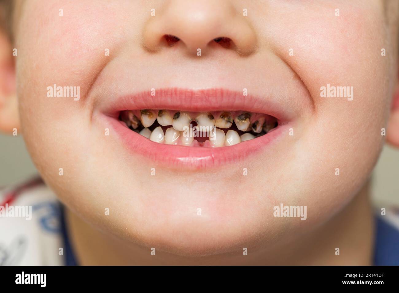 Kid patient open mouth showing cavities teeth decay. Teeth health care ...