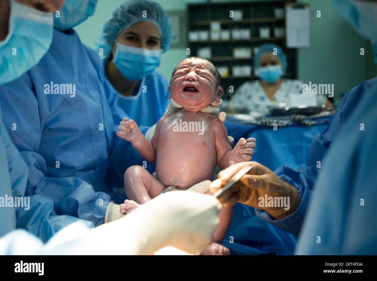 C-section surgery umbilical cord, doctor operating Stock Photo - Alamy
