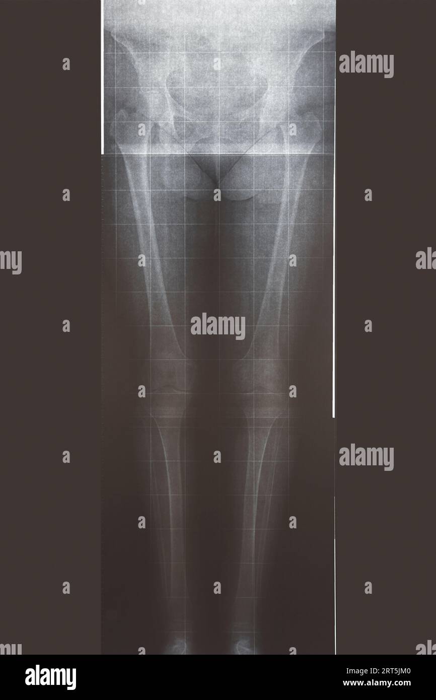 Legs and hip xray. Medical examination. Radiology diagnosis Stock Photo ...