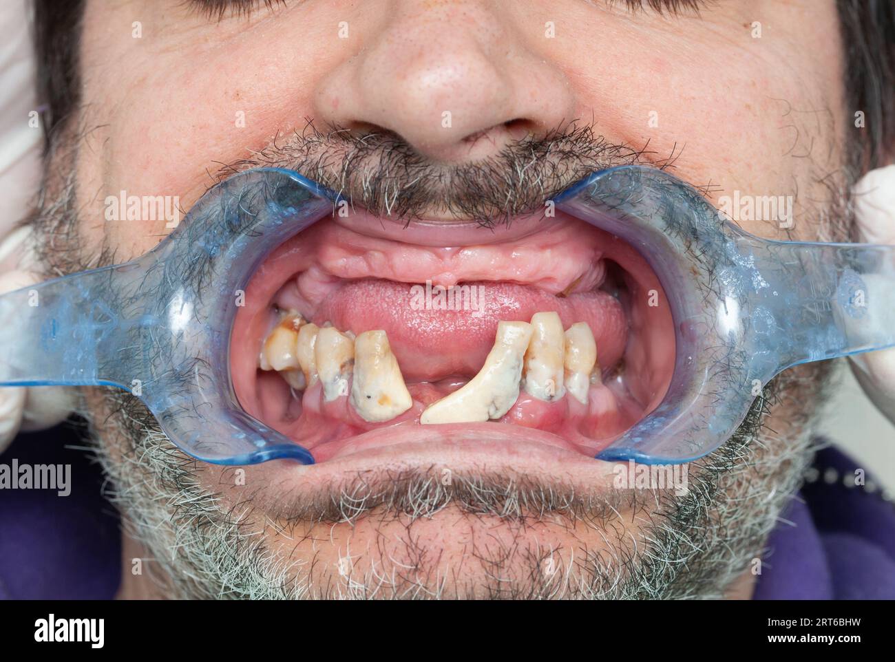 Rotten teeth during inspection with retractor for dental implant design ...