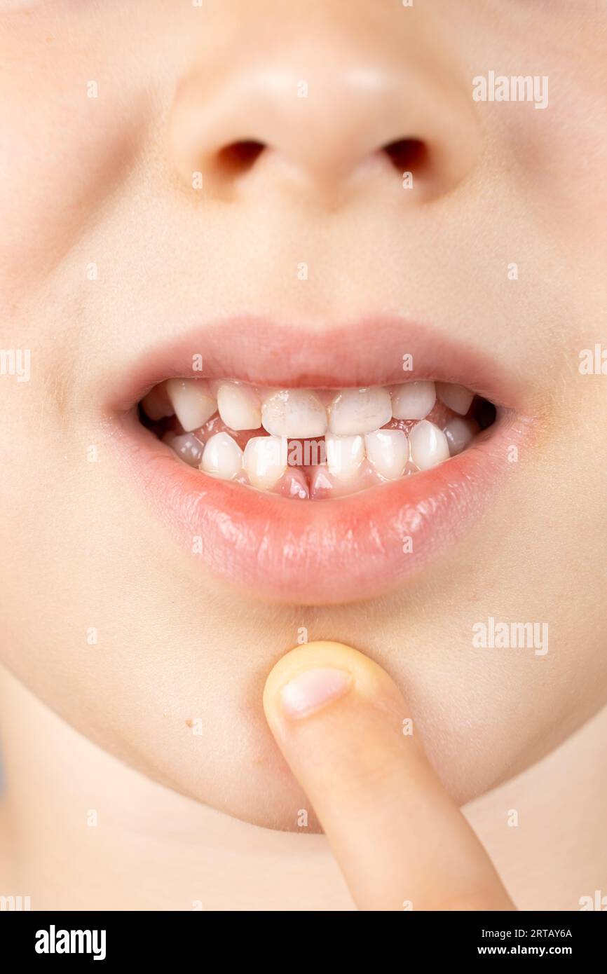 Loss of milk teeth in children. A six-year-old child shows the first ...