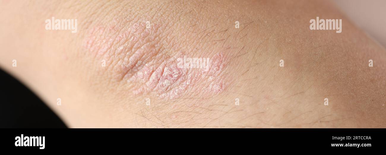 Elbow rash man hi-res stock photography and images - Alamy