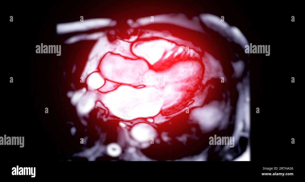 MRI heart or Cardiac MRI ( magnetic resonance imaging ) of heart 3 ...