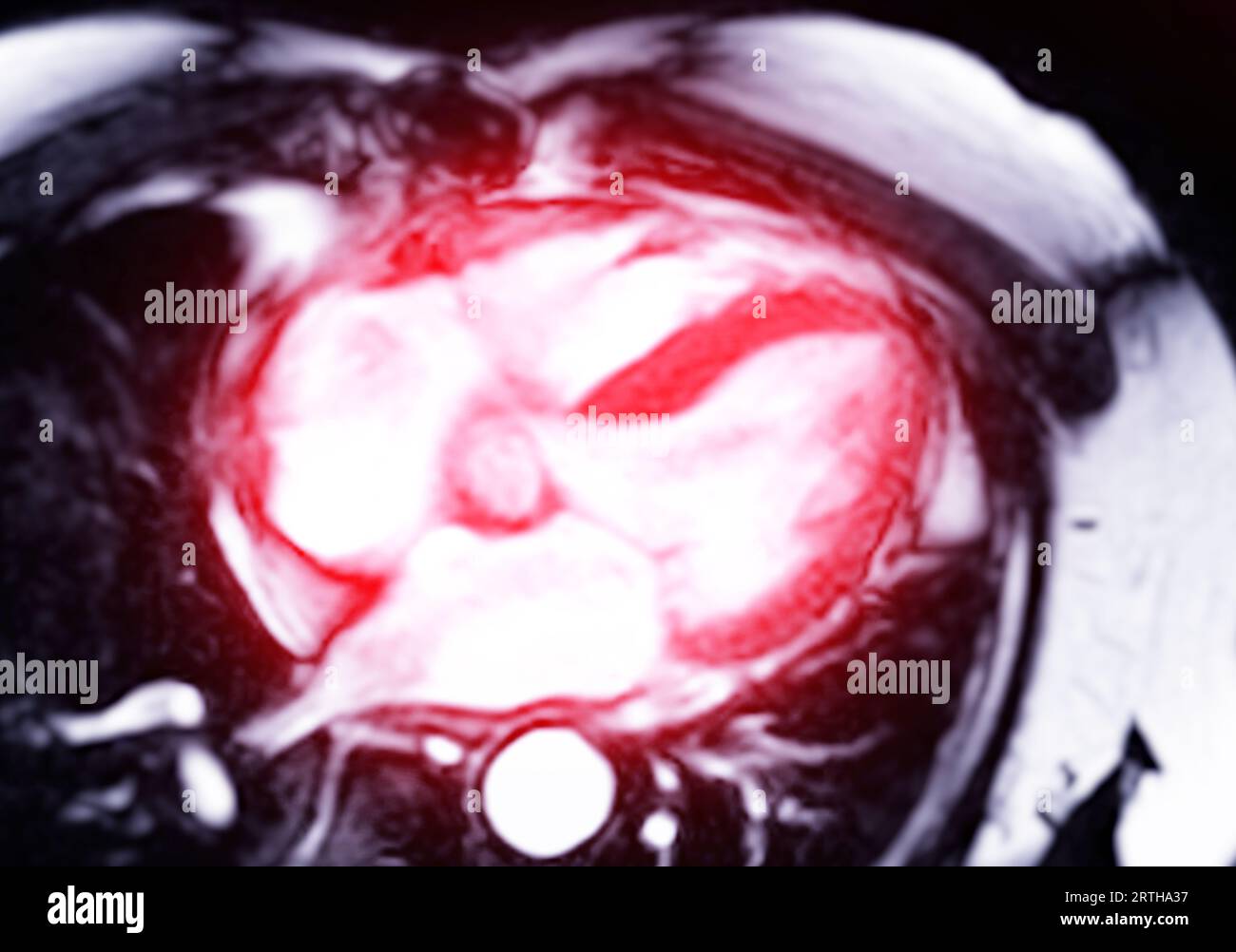 MRI heart or Cardiac MRI ( magnetic resonance imaging ) of heart 4 ...