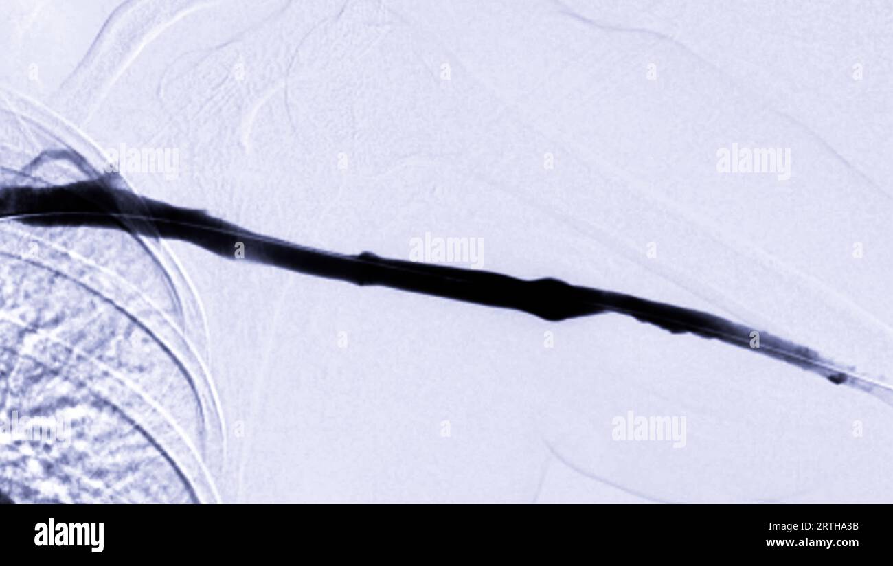 Image of Angioplasty, balloon angioplasty and percutaneous transluminal ...