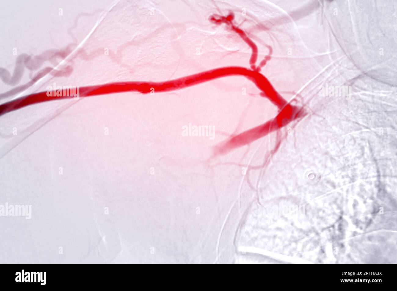 Image of Angioplasty, balloon angioplasty and percutaneous transluminal ...