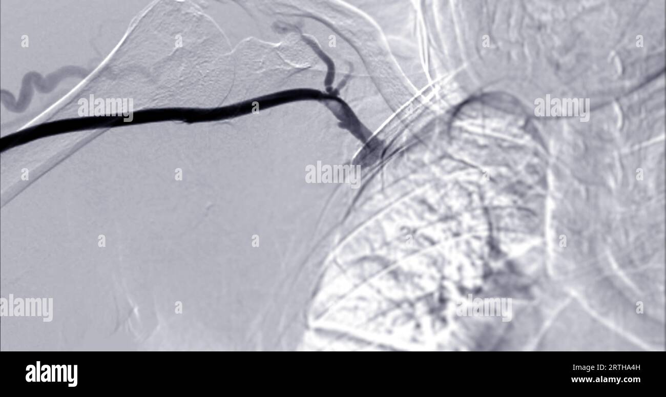 Image of Angioplasty, balloon angioplasty and percutaneous transluminal ...
