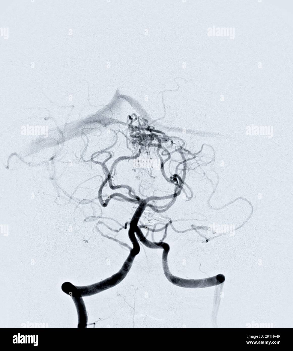 Cerebral angiography image from Fluoroscopy in intervention radiology ...