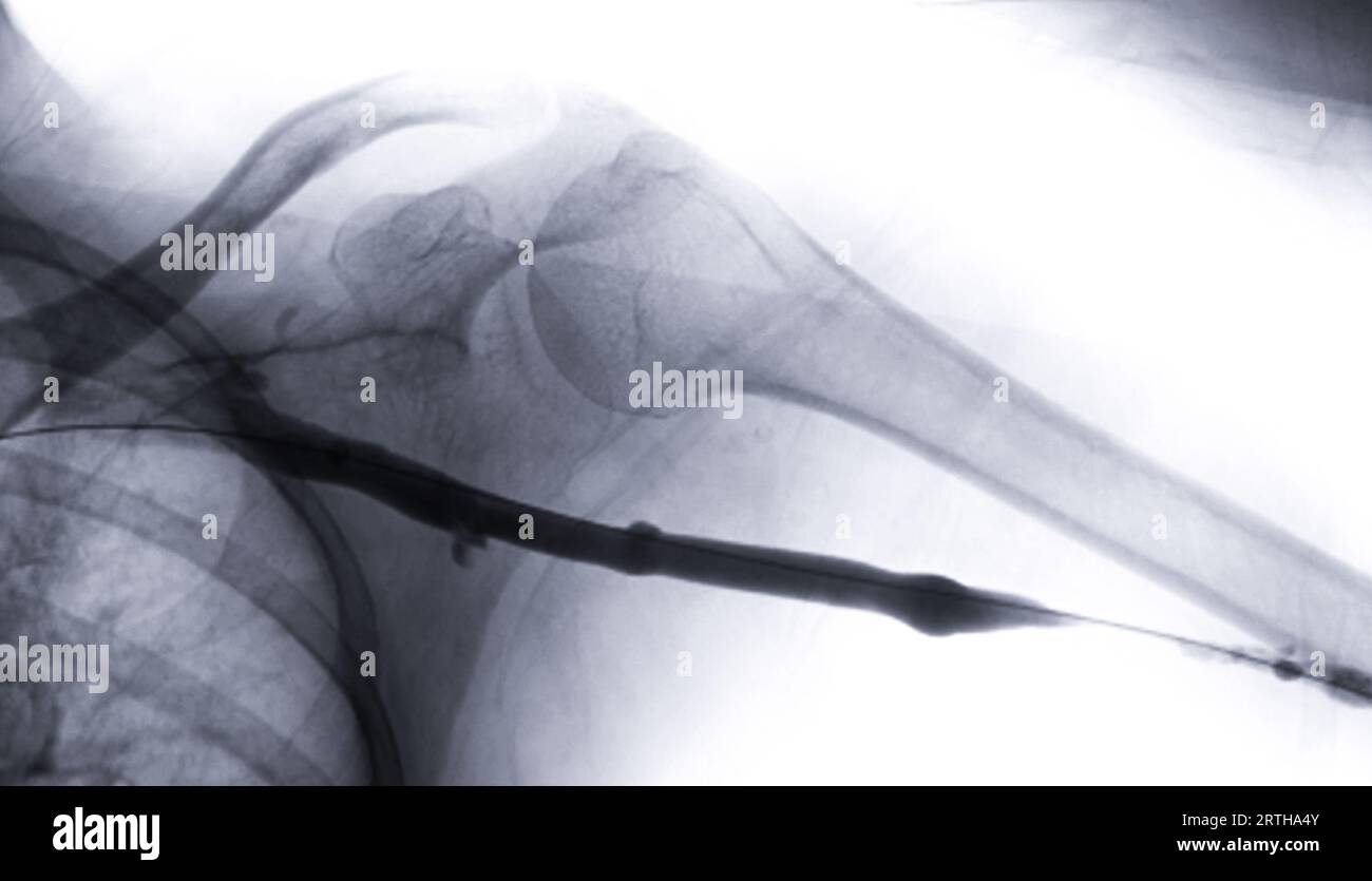 Image of Angioplasty, balloon angioplasty and percutaneous transluminal ...