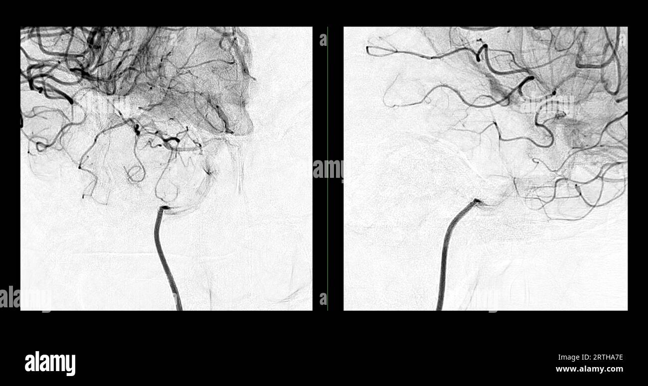 Cerebral angiography image from Fluoroscopy in intervention radiology ...