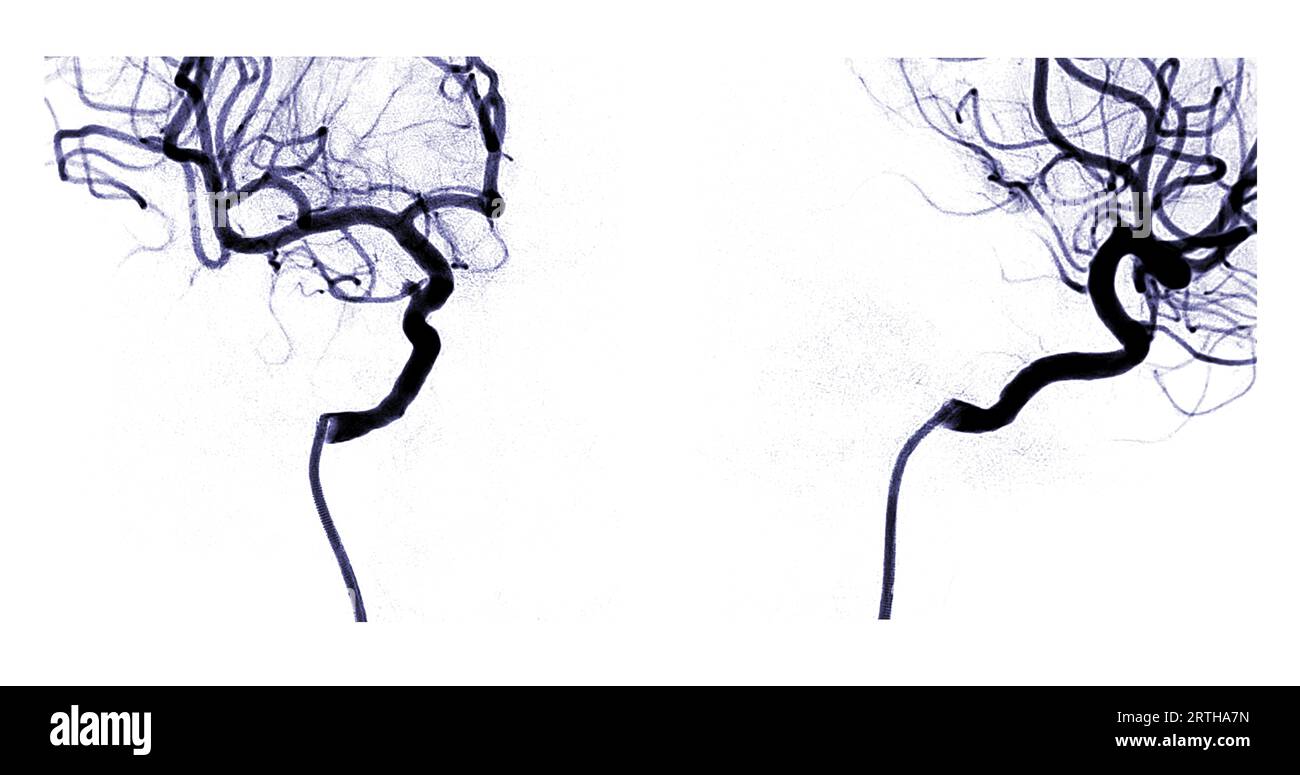 Cerebral angiography image from Fluoroscopy in intervention radiology ...