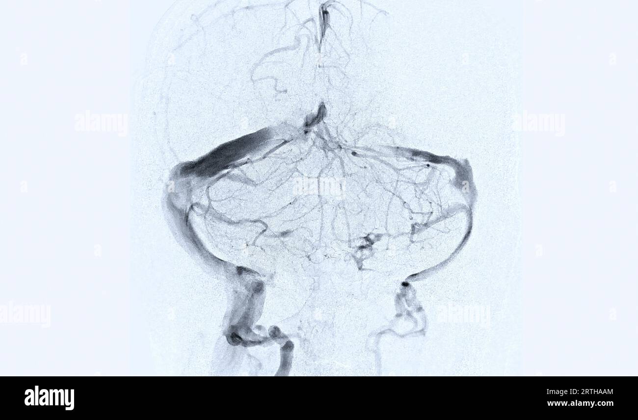 Cerebral angiography image from Fluoroscopy in intervention radiology ...