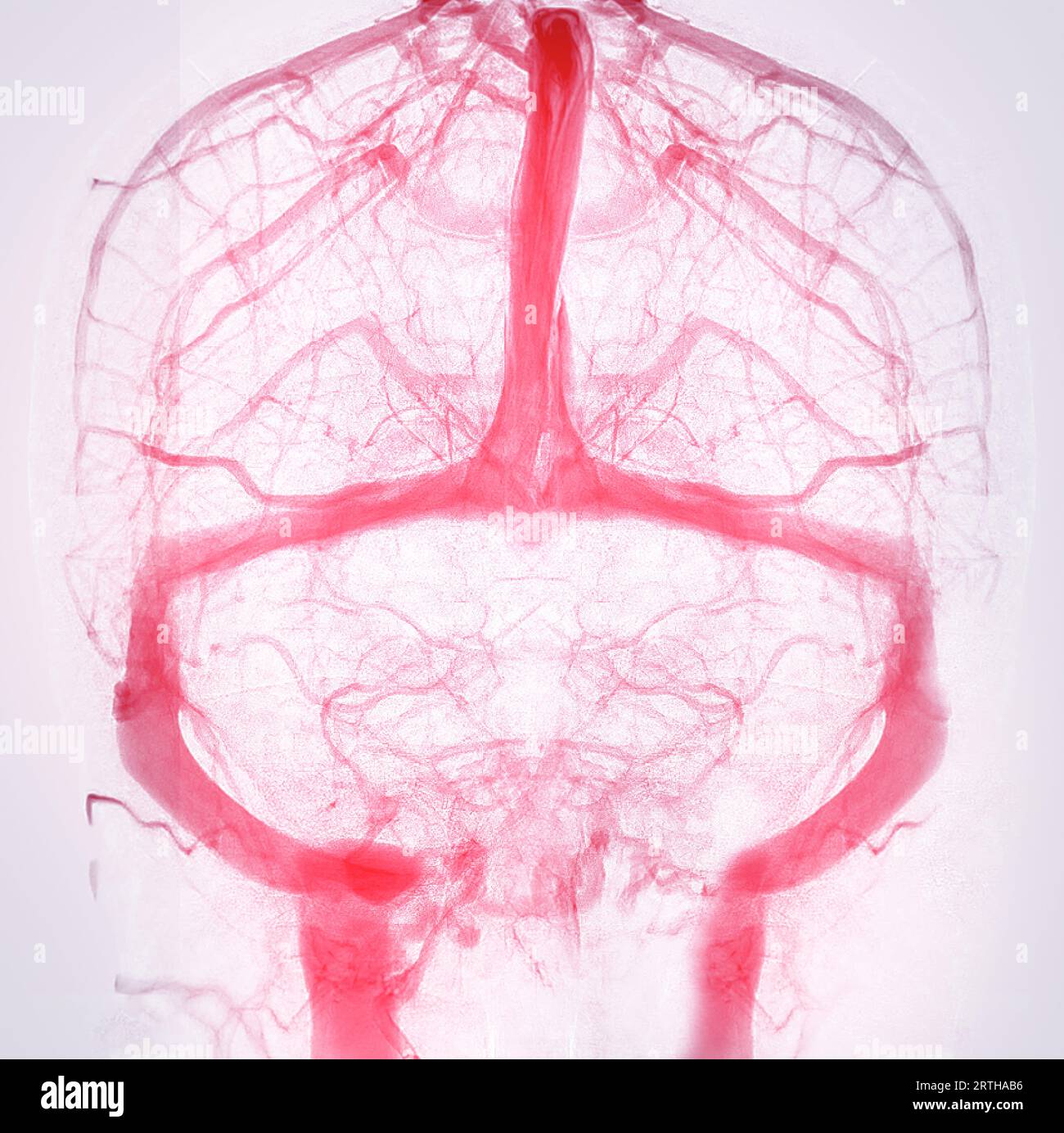 Cerebral angiography image from Fluoroscopy in intervention radiology ...