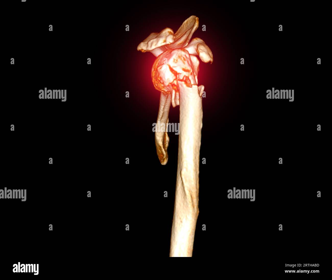 CT scan 3D rendering of shoulder joint showing fracture head of humerus ...