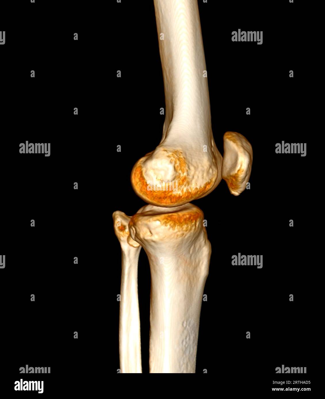 CT Scan of Knee joint 3D rendering Showing fracture of Patella Stock ...